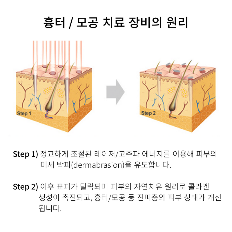 여드름제거 압구정미인